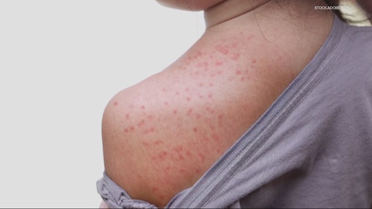 Oregon Health Authority identifies another measles exposure site at ...