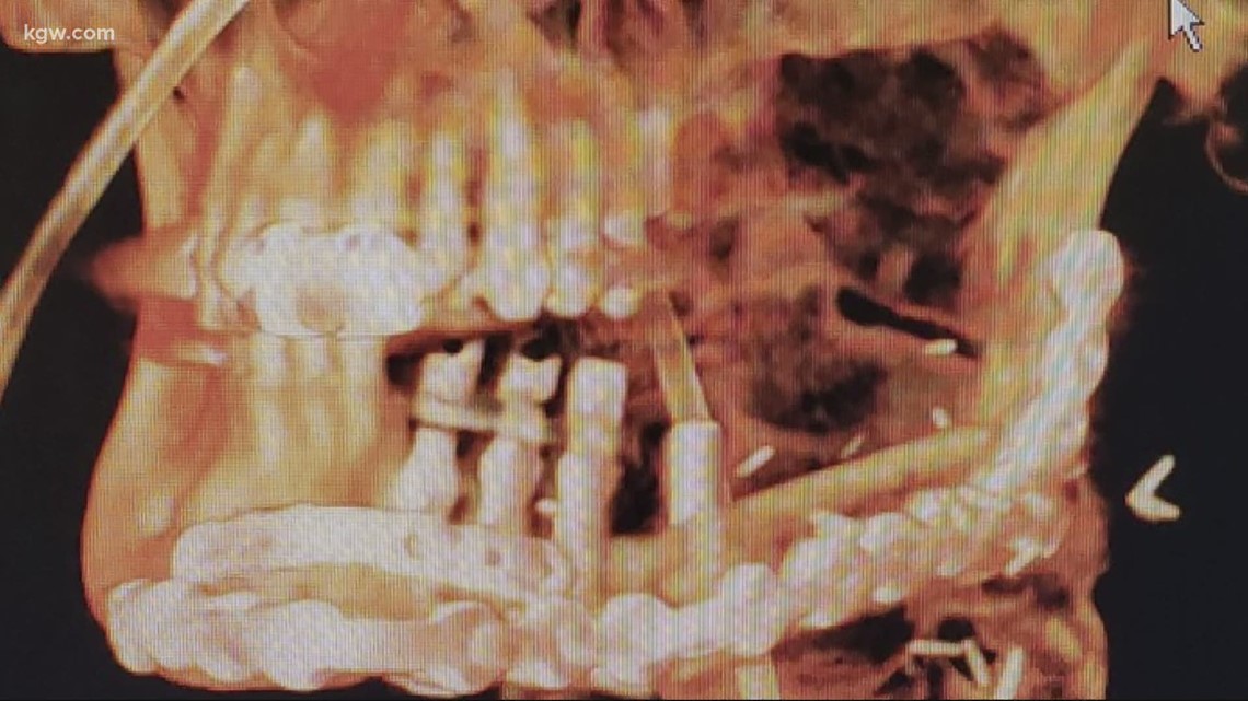 Providence performs first ‘Jaw in a Day’ surgery in Oregon | kgw.com