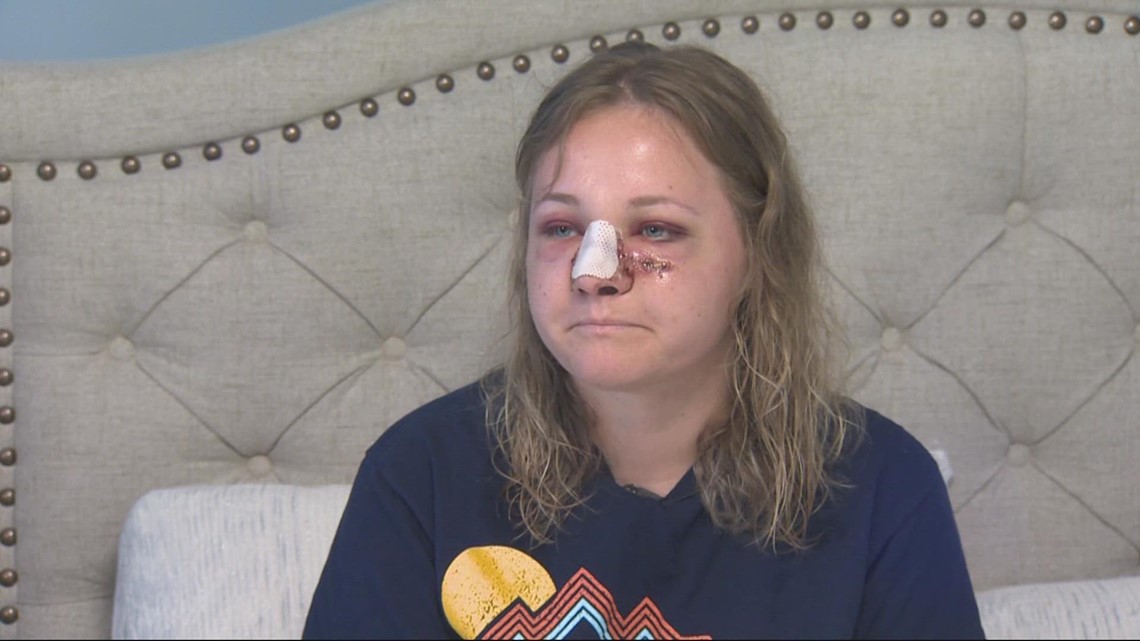 Gresham Woman Recovering After Being Shot In The Face